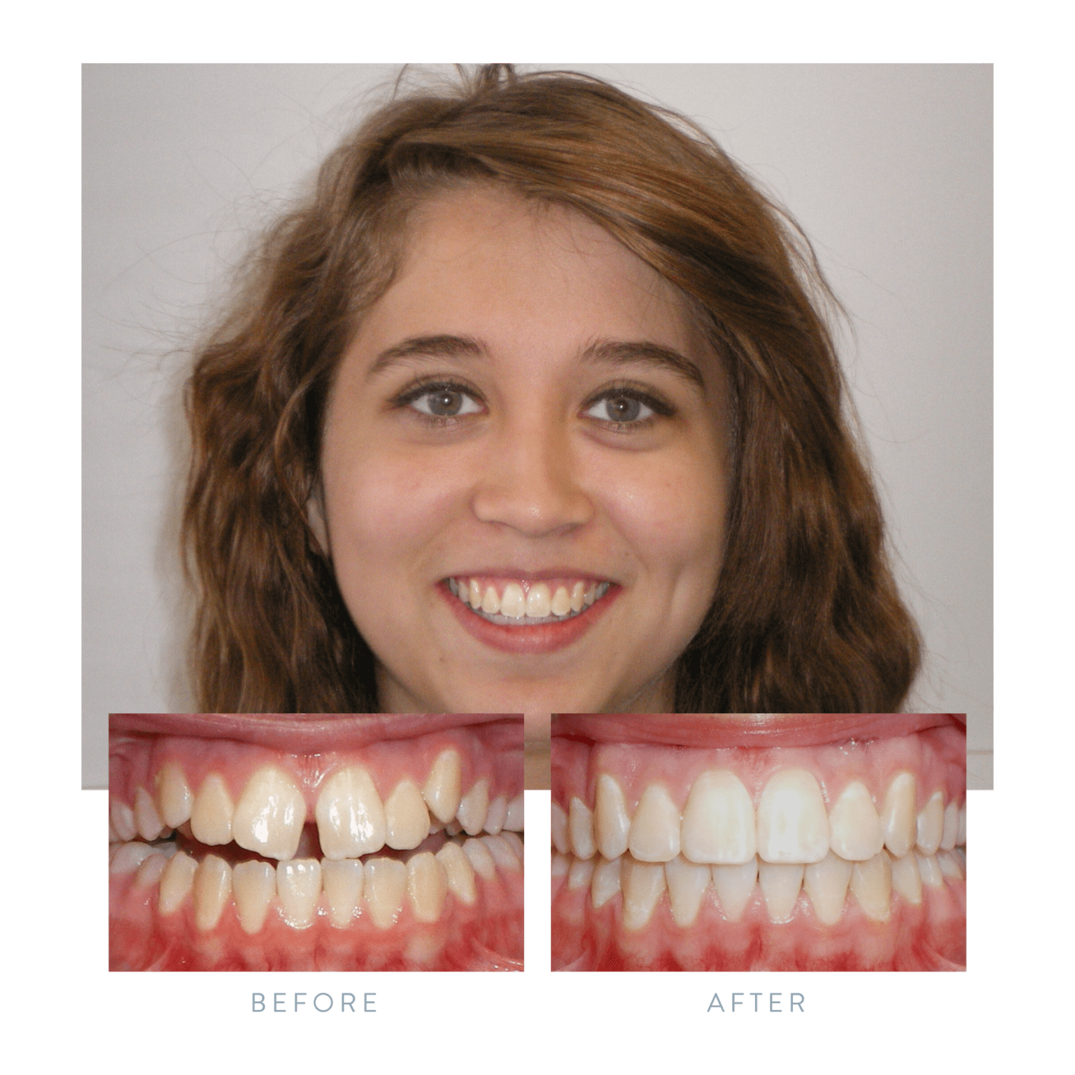 Before & Afters | Orthodontics Lake Oswego | Delplanche Orthodontics